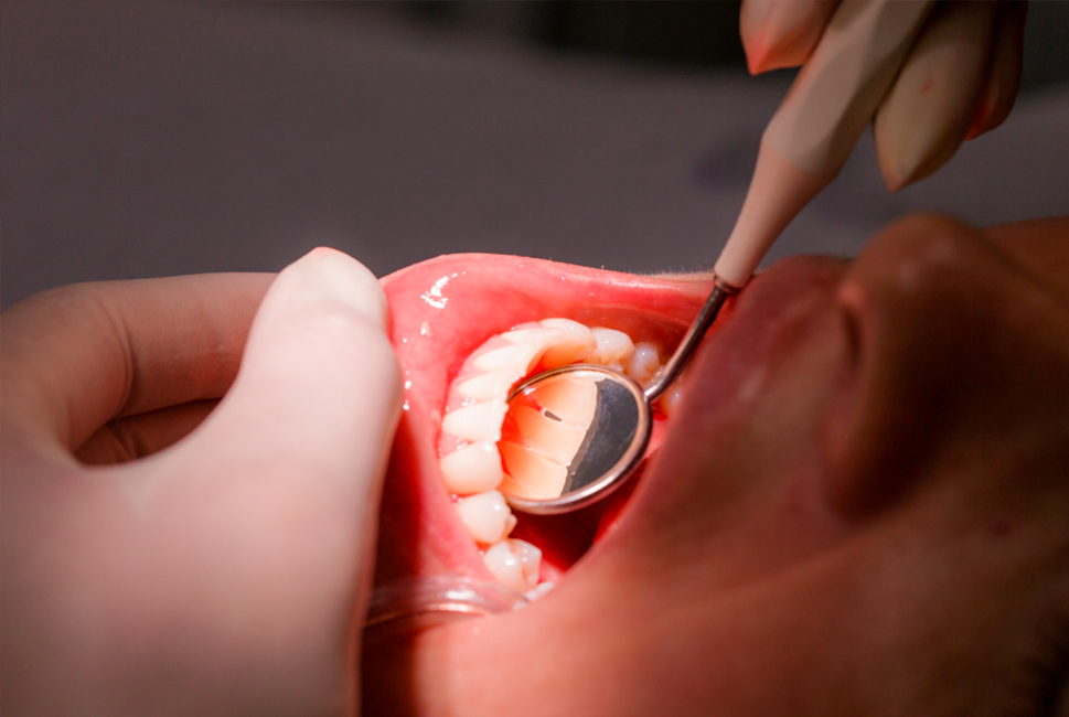 4 Signs you Need a Periodontist | Dr. Terence Jackson